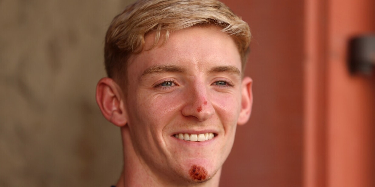 Inghilterra, che paura per Gordon: cade in bici e si riduce così!